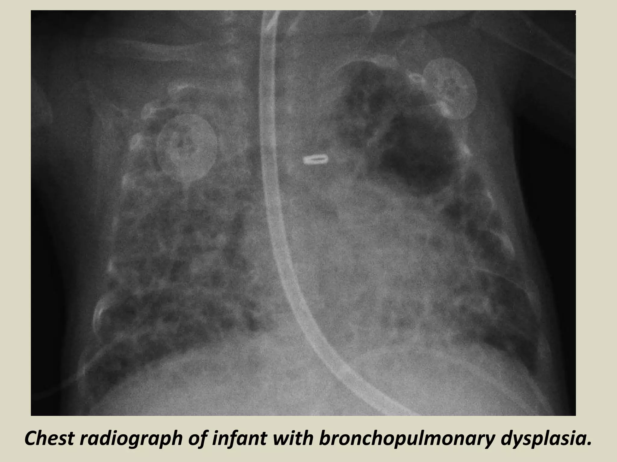 Presentation1.pptx, radiological imaging of neonatal lung disease. | PPTX