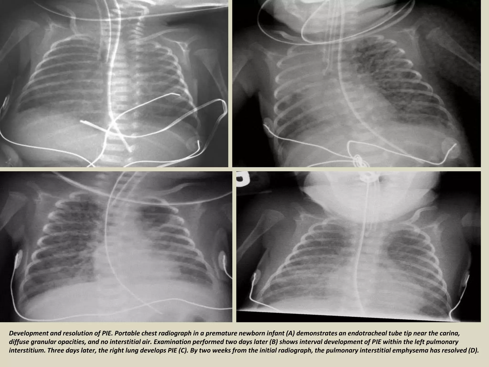 Presentation1.pptx, radiological imaging of neonatal lung disease. | PPTX