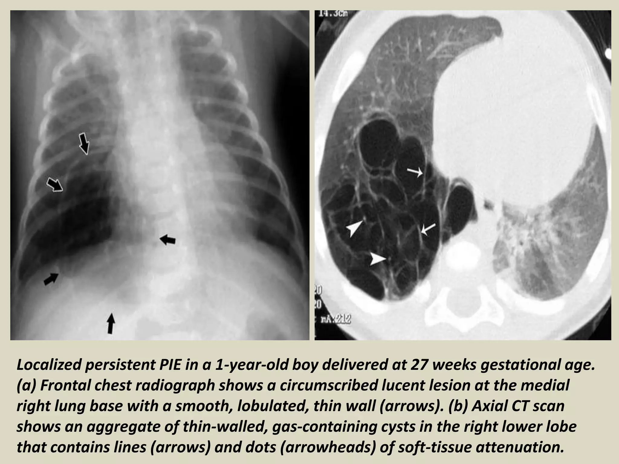 Presentation1.pptx, radiological imaging of neonatal lung disease. | PPTX