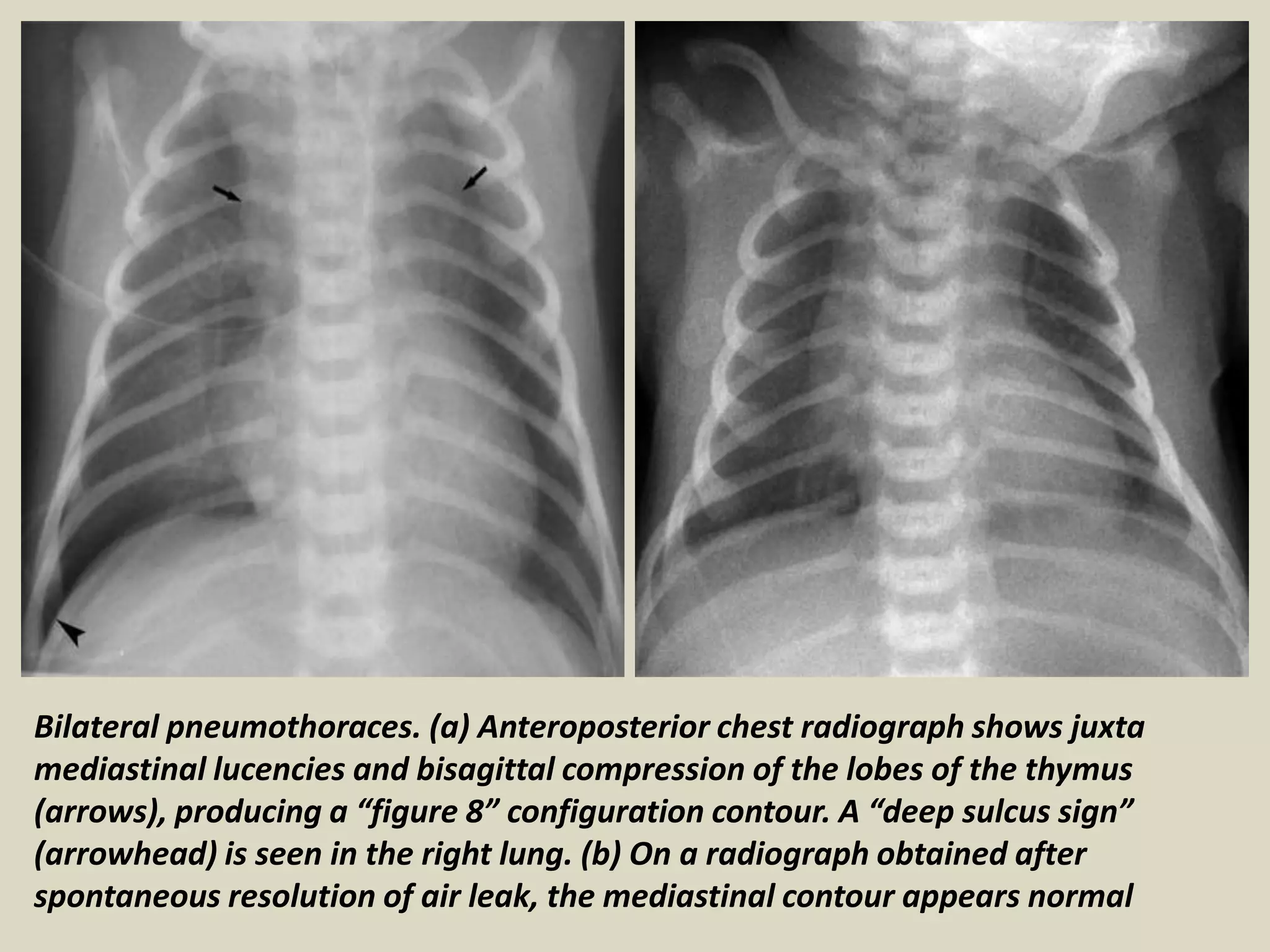 Presentation1.pptx, radiological imaging of neonatal lung disease. | PPTX