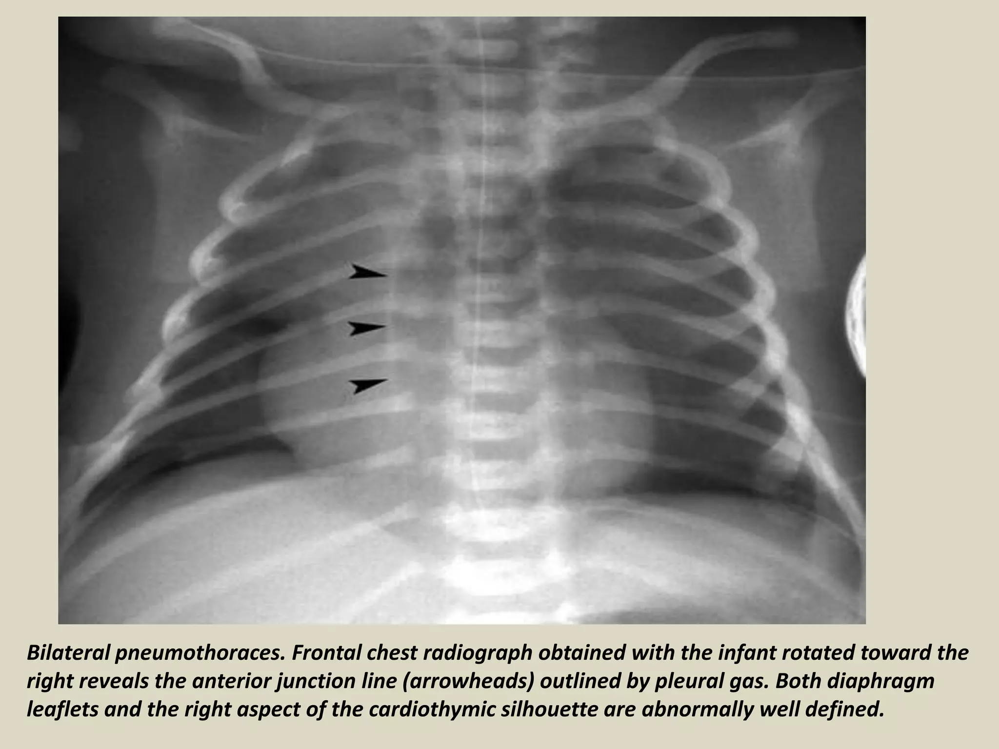 Presentation1.pptx, radiological imaging of neonatal lung disease. | PPTX