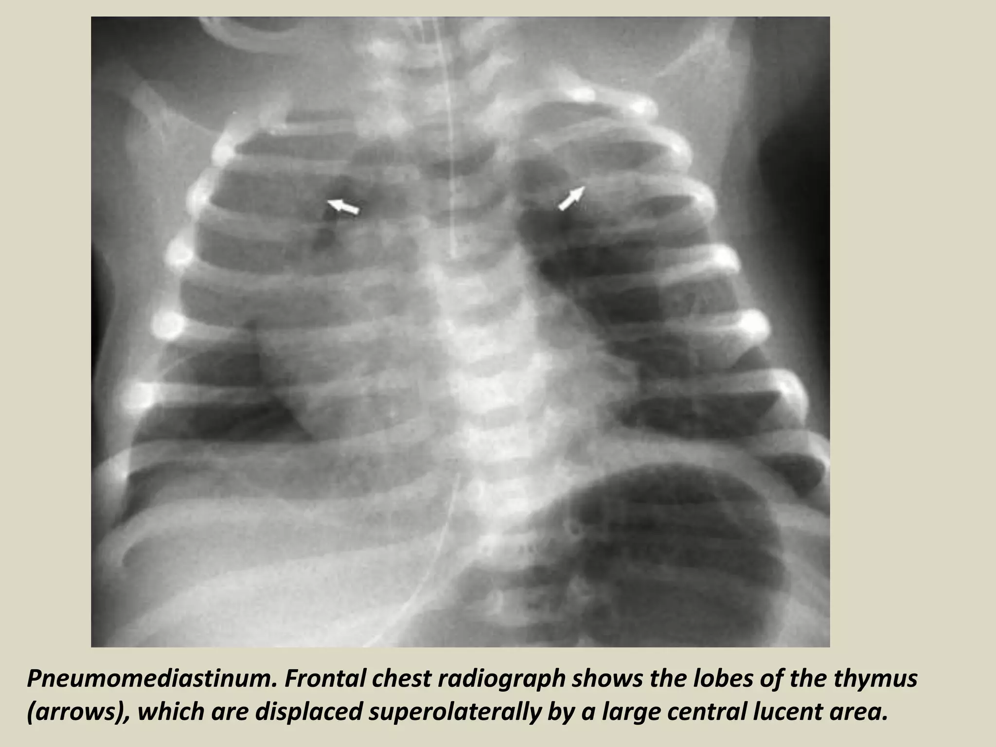 Presentation1.pptx, radiological imaging of neonatal lung disease. | PPTX