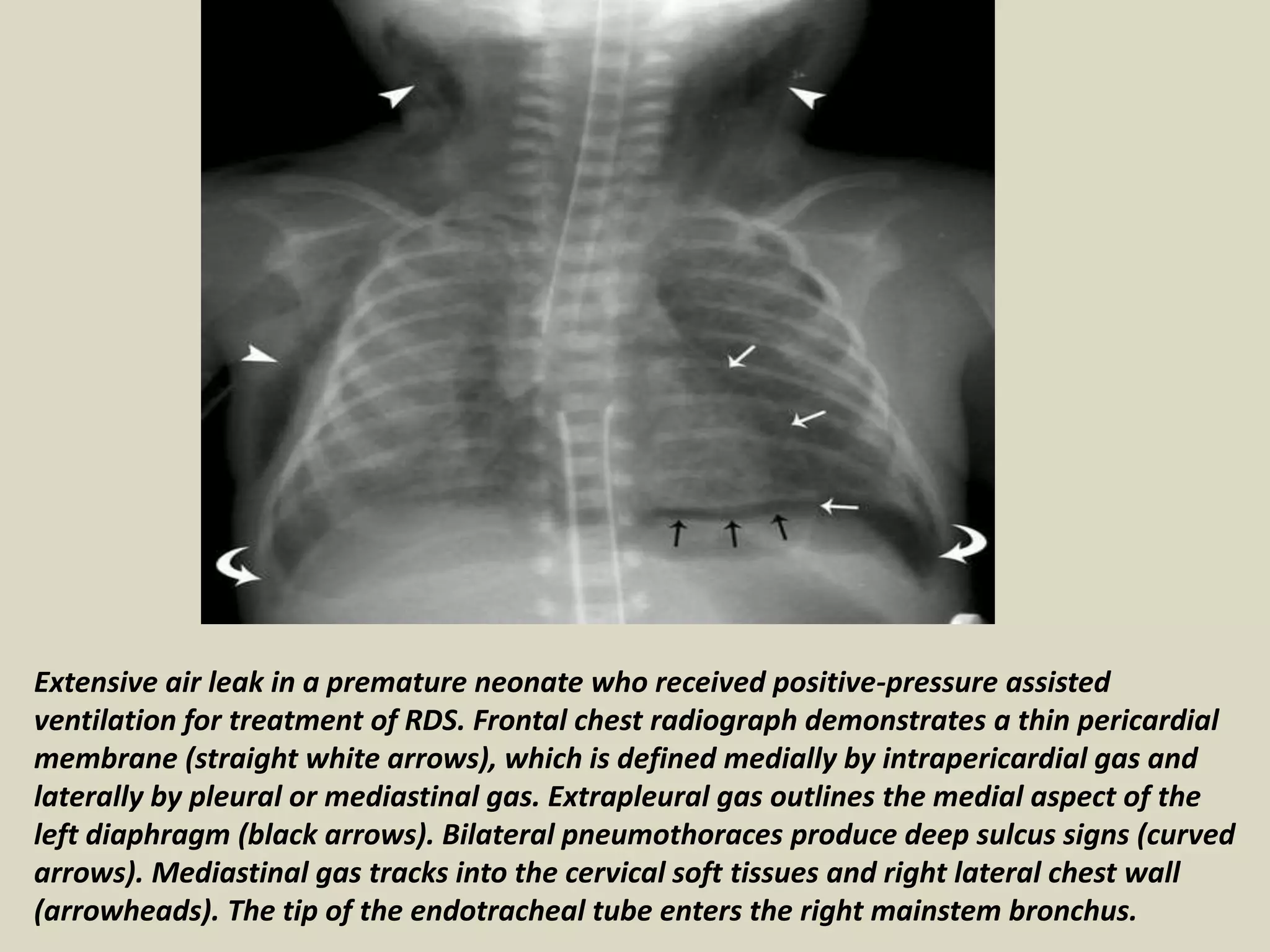 Presentation1.pptx, radiological imaging of neonatal lung disease. | PPTX