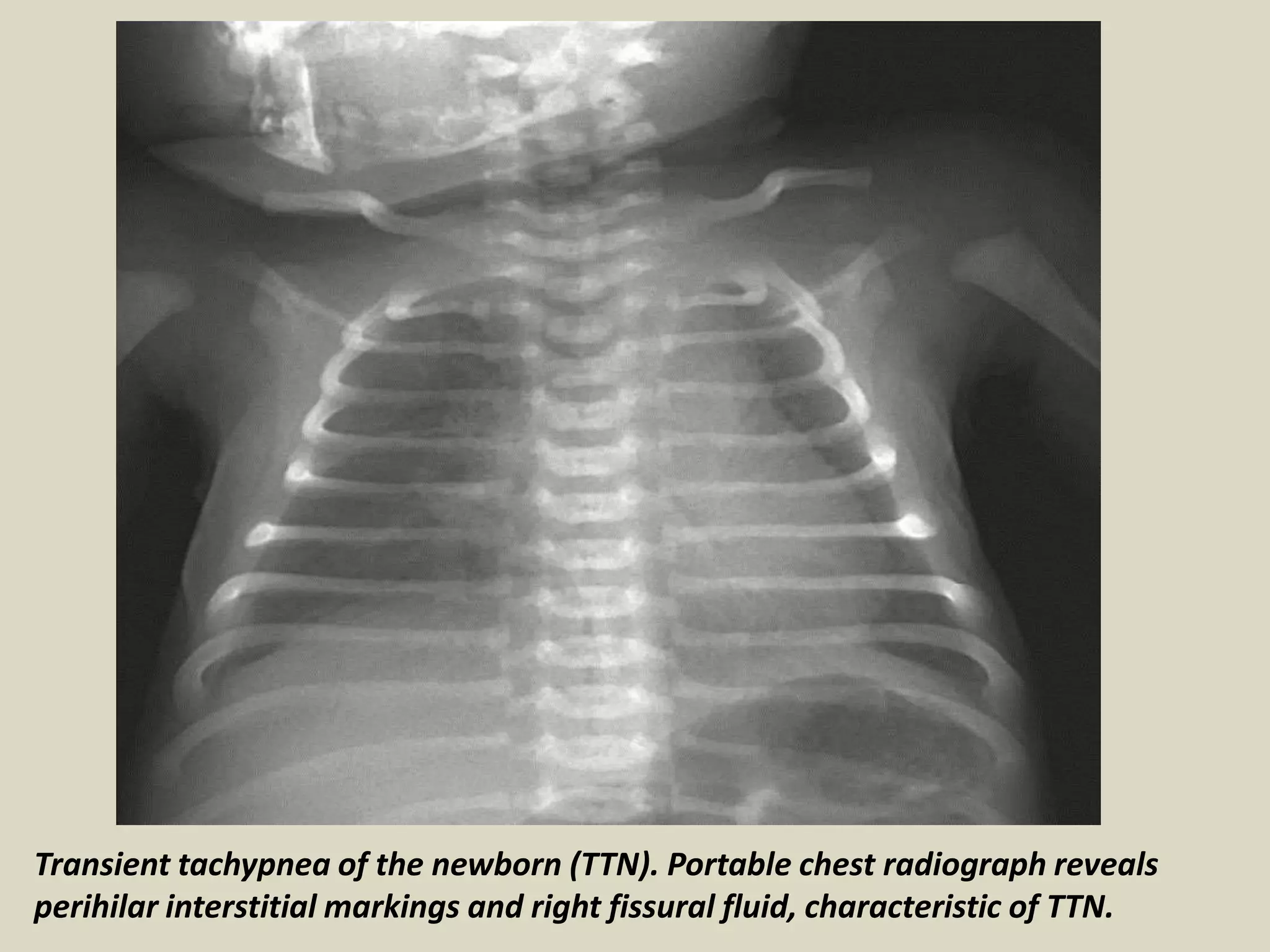 Presentation1.pptx, radiological imaging of neonatal lung disease. | PPTX