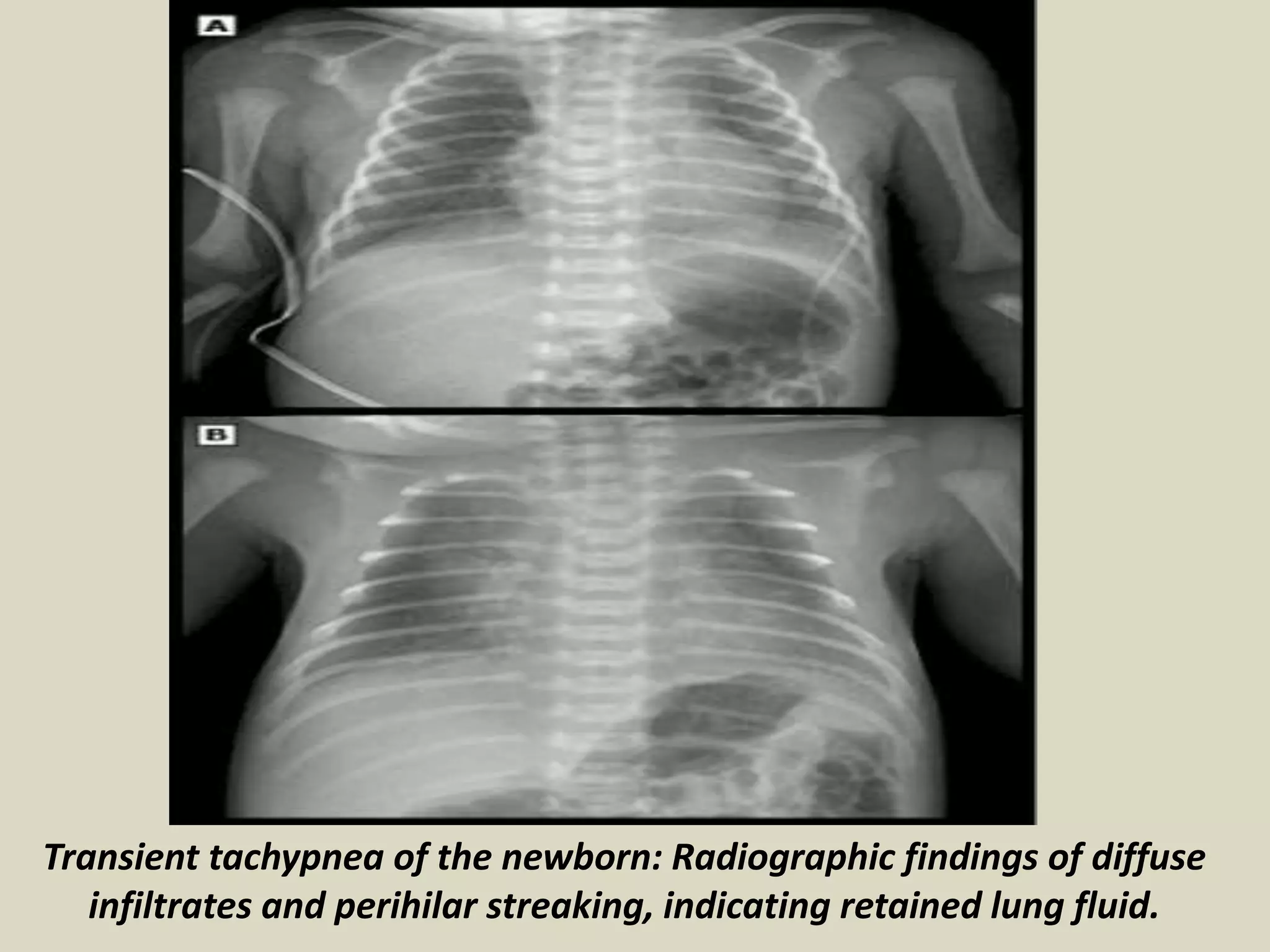 Presentation1.pptx, radiological imaging of neonatal lung disease. | PPTX