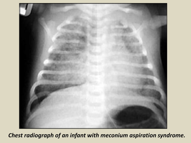Presentation1.pptx, radiological imaging of neonatal lung disease ...