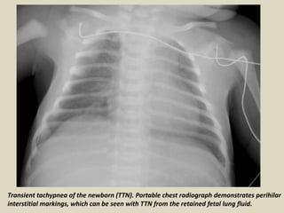 Presentation1.pptx, radiological imaging of neonatal lung disease. | PPTX