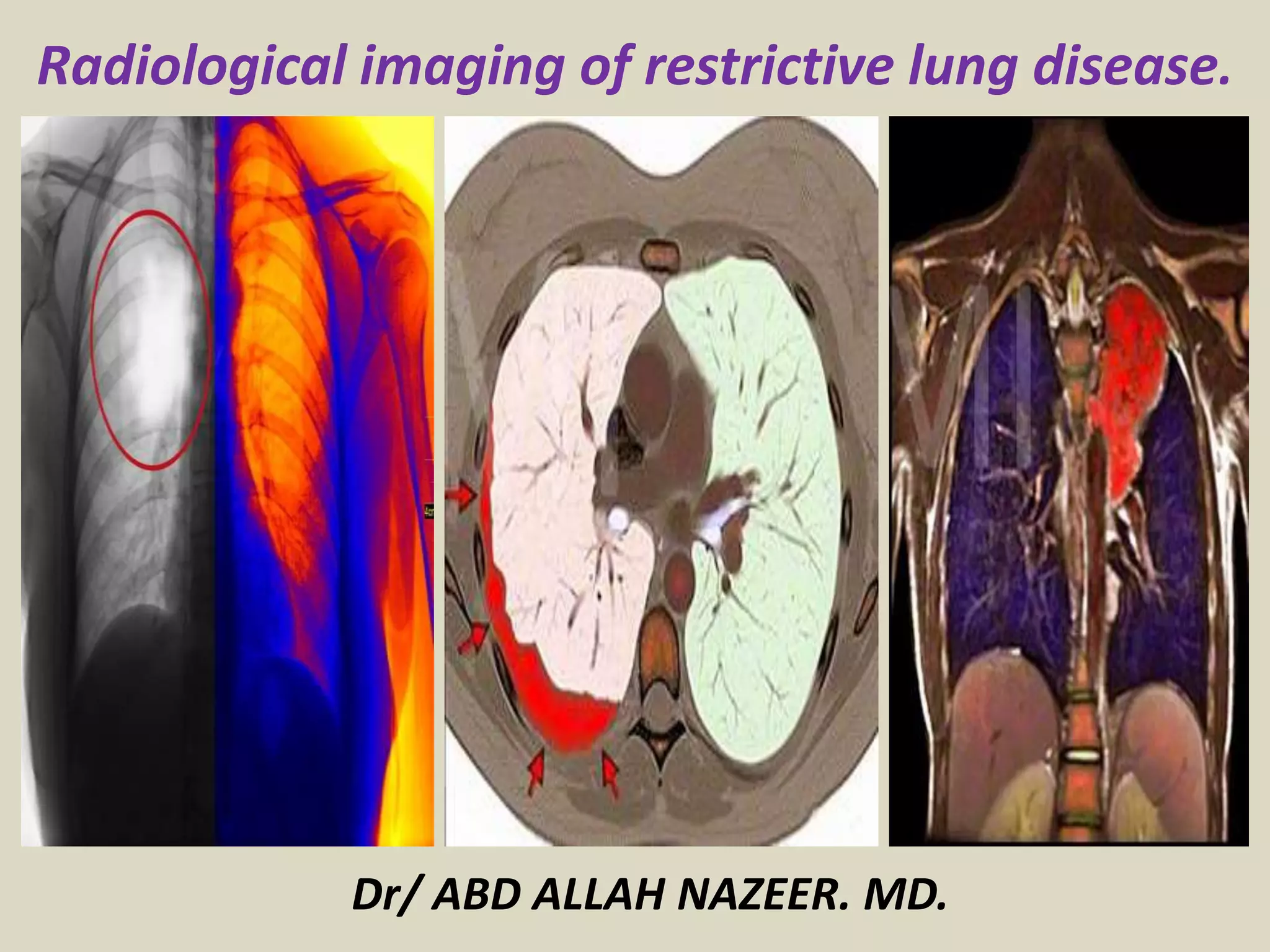 Presentation1.pptx, radiological imaging of restrictive lung diseases ...