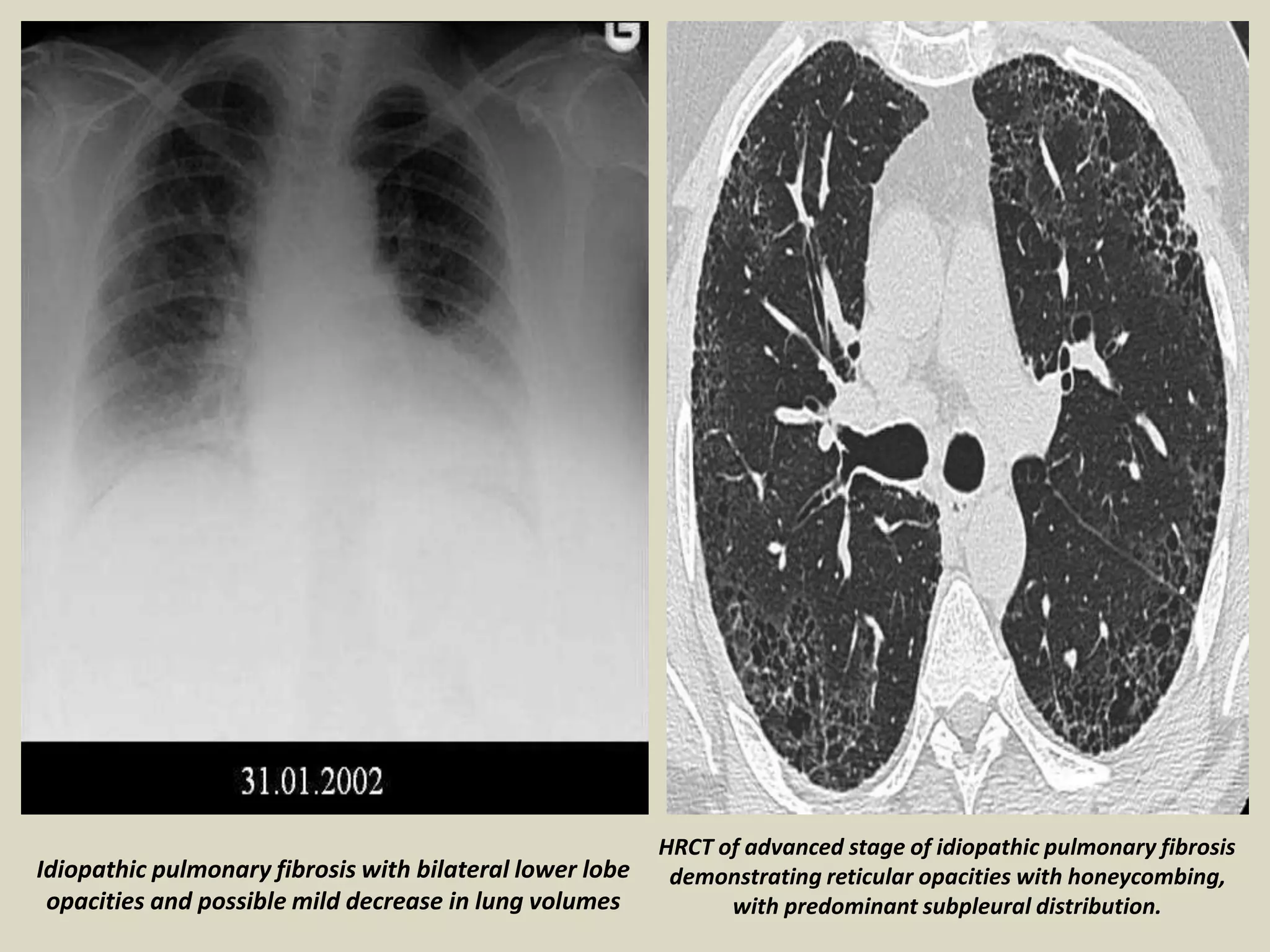 Presentation1.pptx, radiological imaging of restrictive lung diseases ...