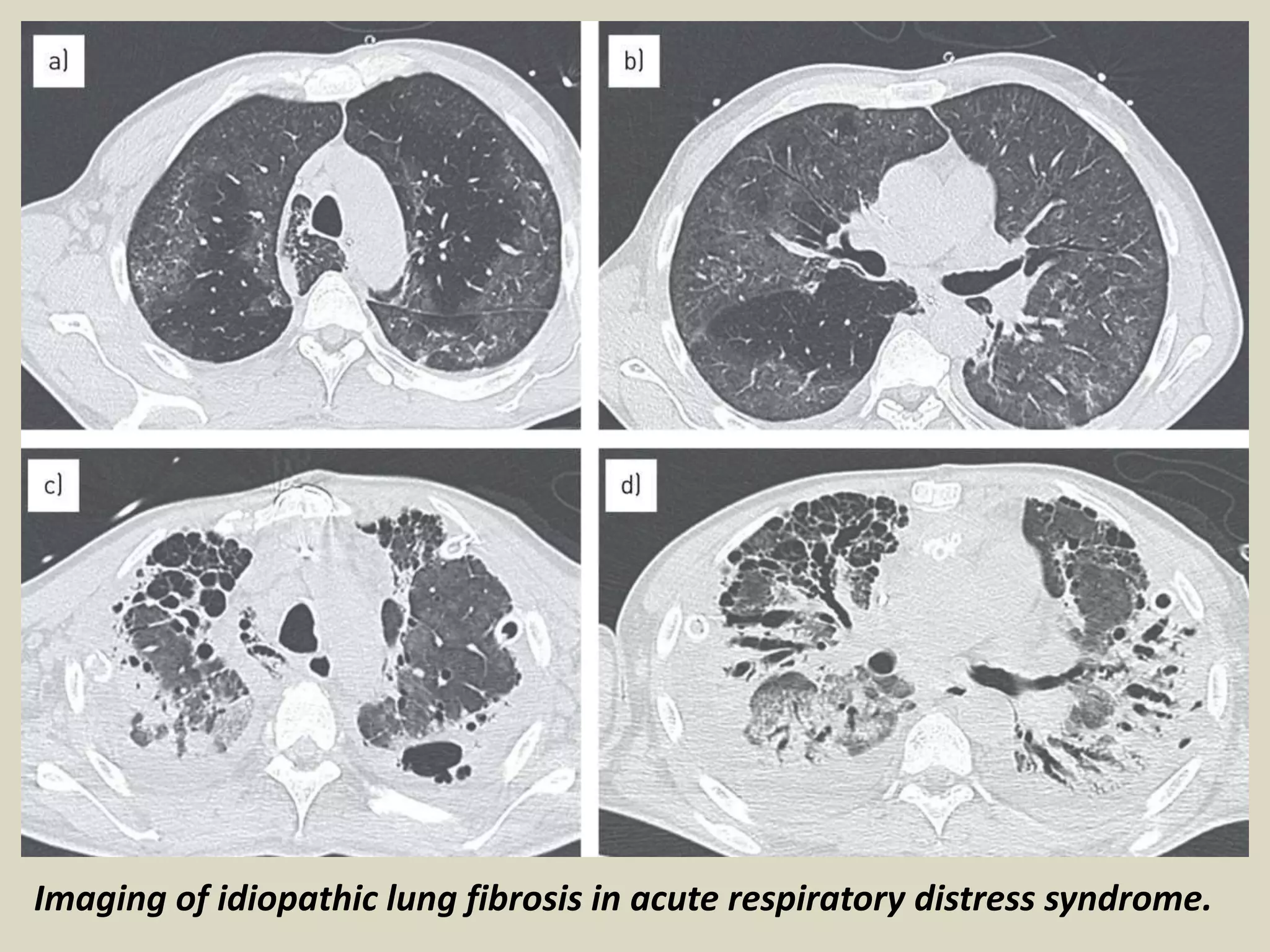 Presentation1.pptx, radiological imaging of restrictive lung diseases ...