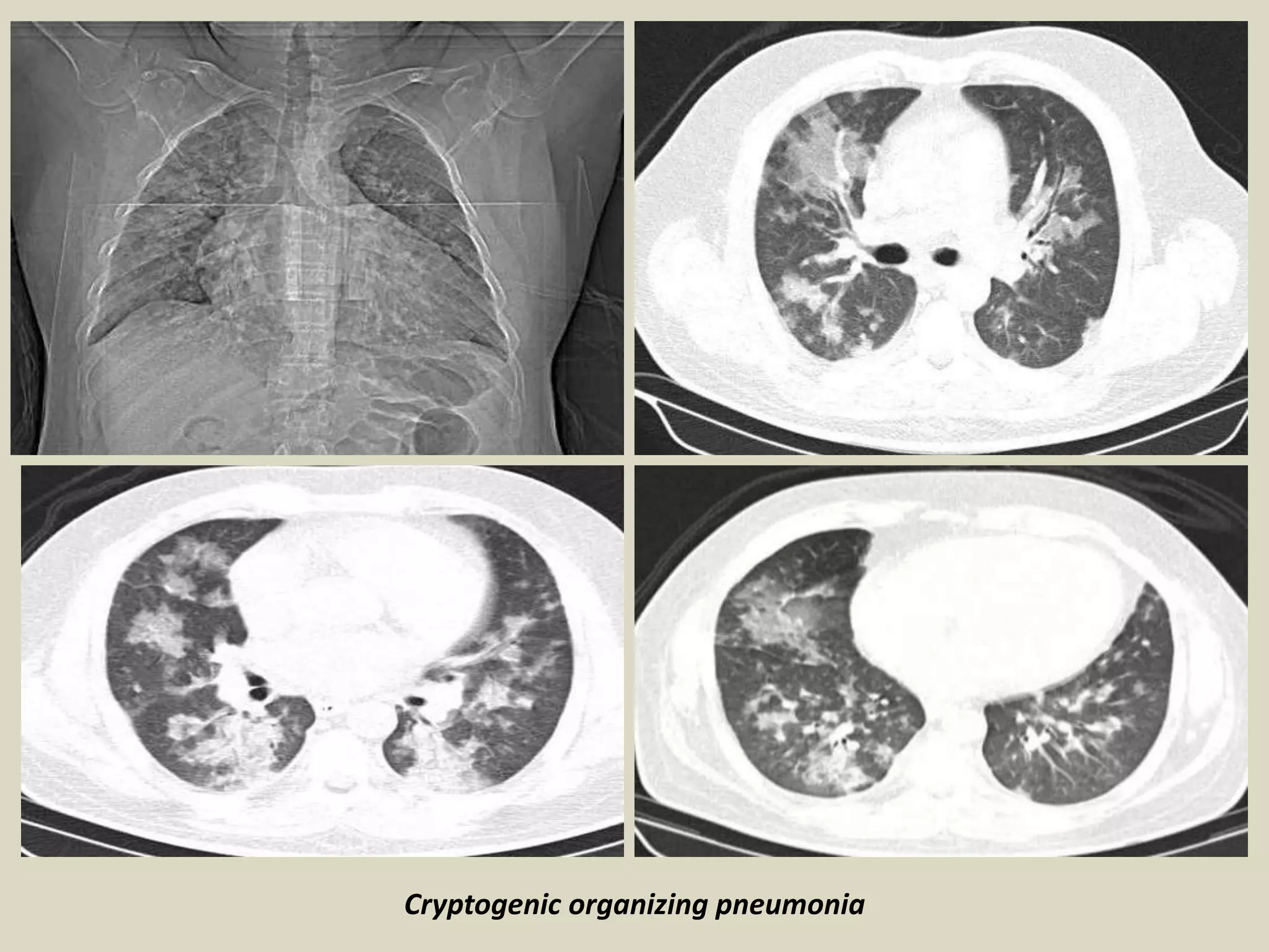 Presentation1.pptx, radiological imaging of restrictive lung diseases ...