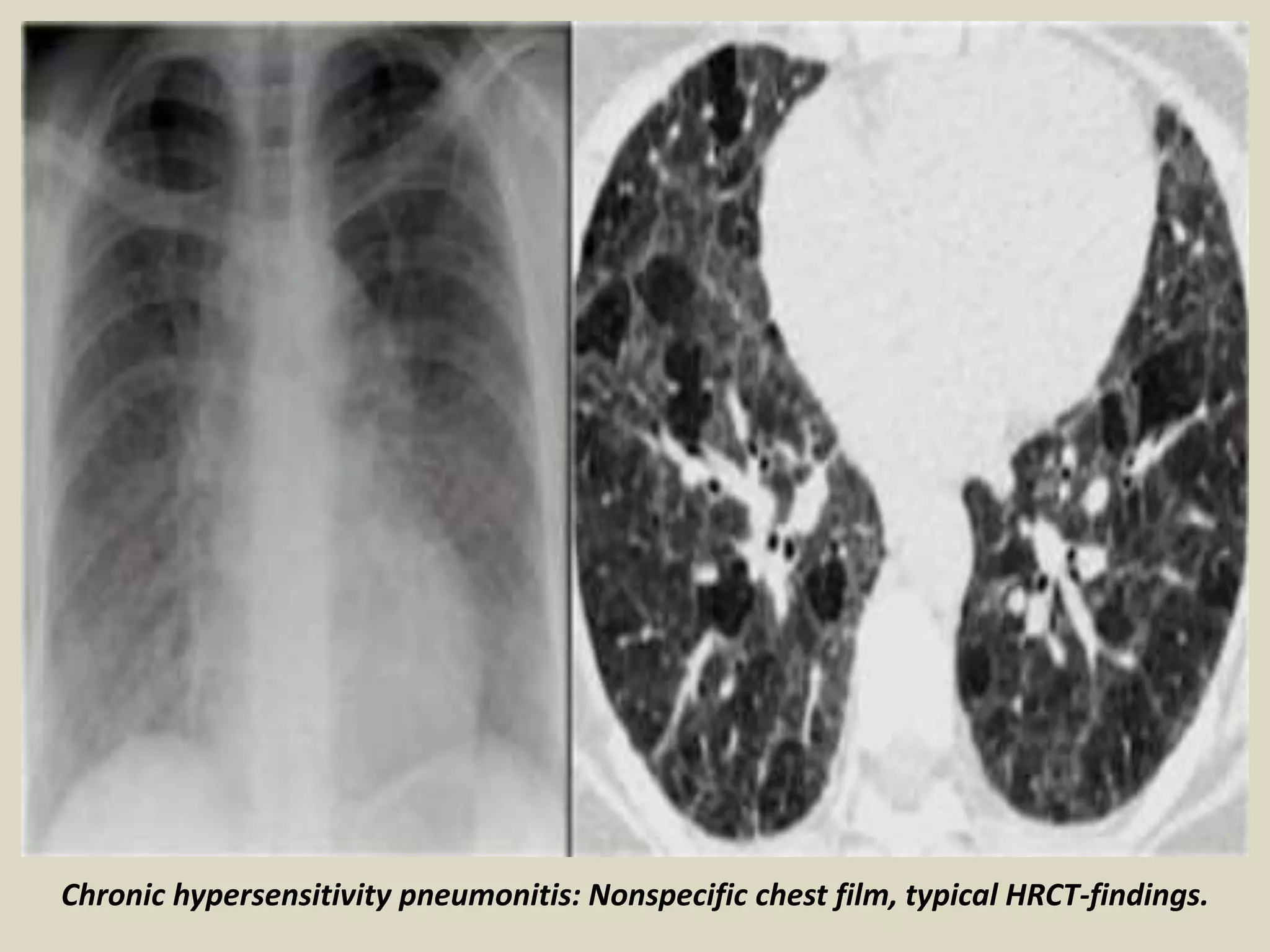 Presentation1.pptx, radiological imaging of restrictive lung diseases ...