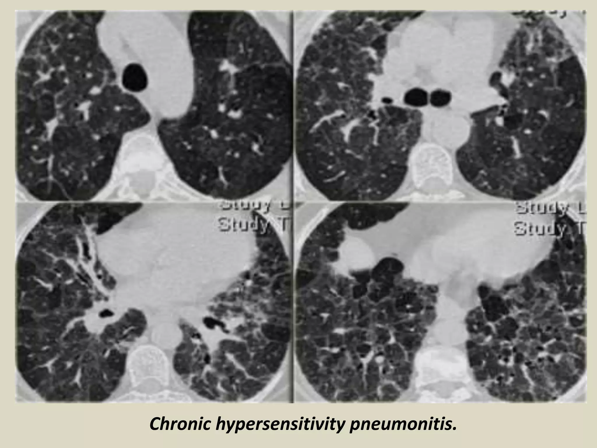 Presentation1.pptx, radiological imaging of restrictive lung diseases ...