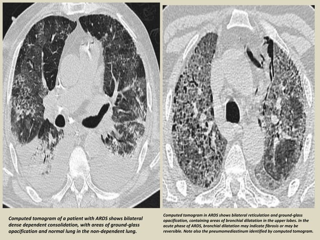 Presentation1.pptx, radiological imaging of restrictive lung diseases ...