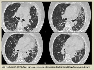 Presentation1.pptx, radiological imaging of restrictive lung diseases ...