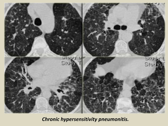Presentation1.pptx, radiological imaging of restrictive lung diseases ...