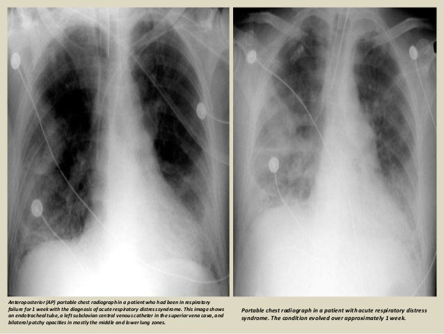 Presentation1.pptx, radiological imaging of restrictive lung diseases.
