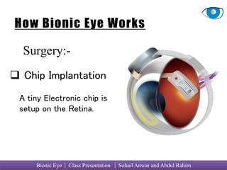 Bionic Eye | PPT