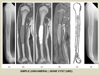 Presentation1.pptx, radiological imaging of benign bone tumour. | PPTX