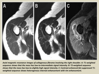 Presentation1.pptx, radiological imaging of benign bone tumour. | PPTX