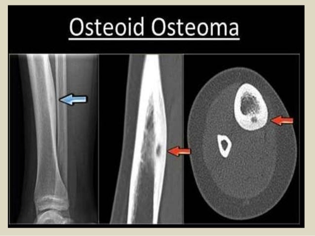 Rit Radiology Osteoid Osteoma