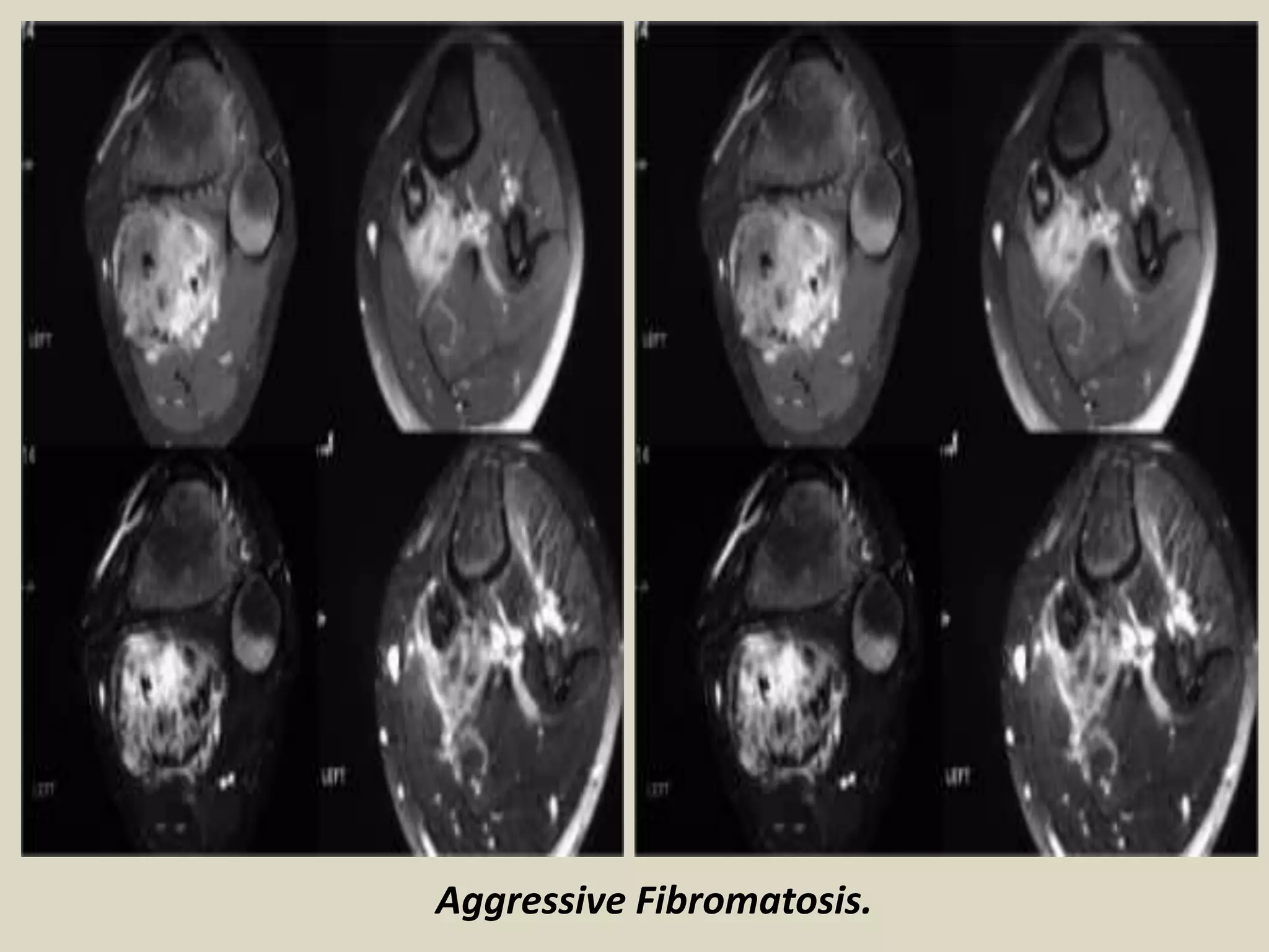 Presentation1.pptx radio;ogical imaging of benign and malignant soft ...