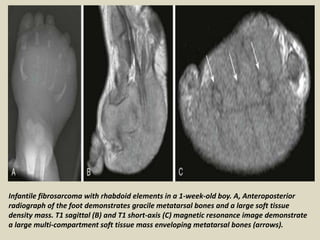 Presentation1.pptx radio;ogical imaging of benign and malignant soft ...