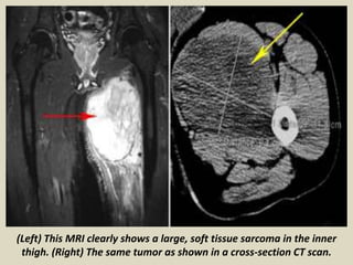 Presentation1.pptx radio;ogical imaging of benign and malignant soft ...