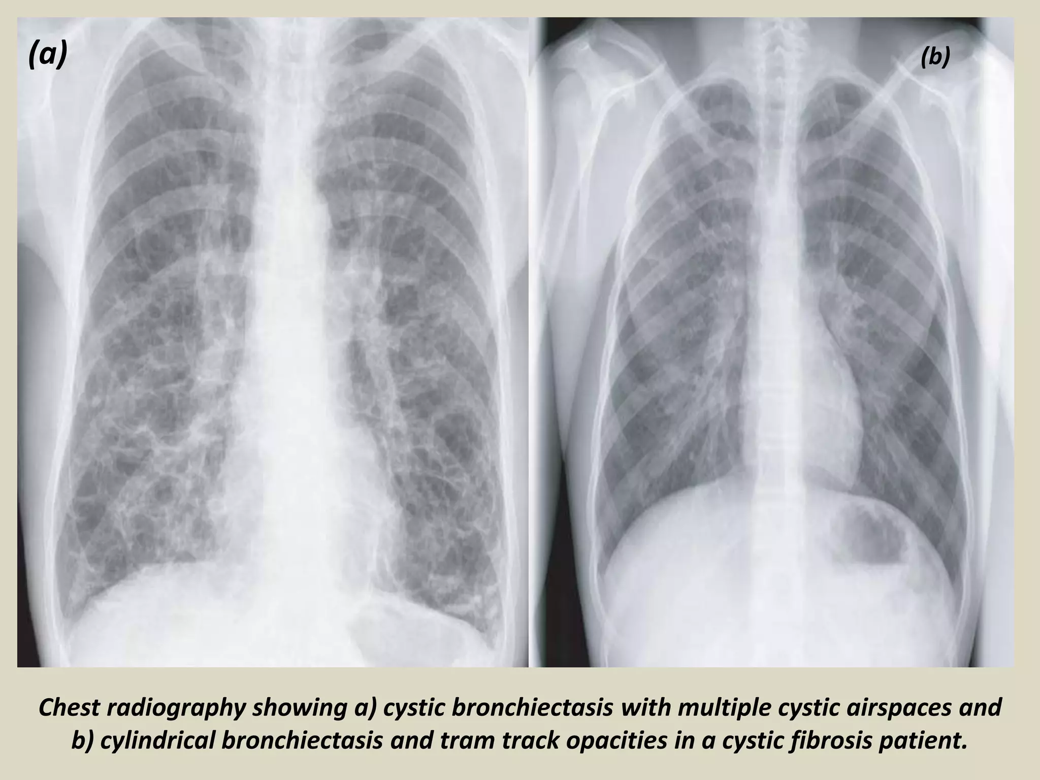 Presentation1.pptx, radiological imaging of bronchiectasis. | PPTX
