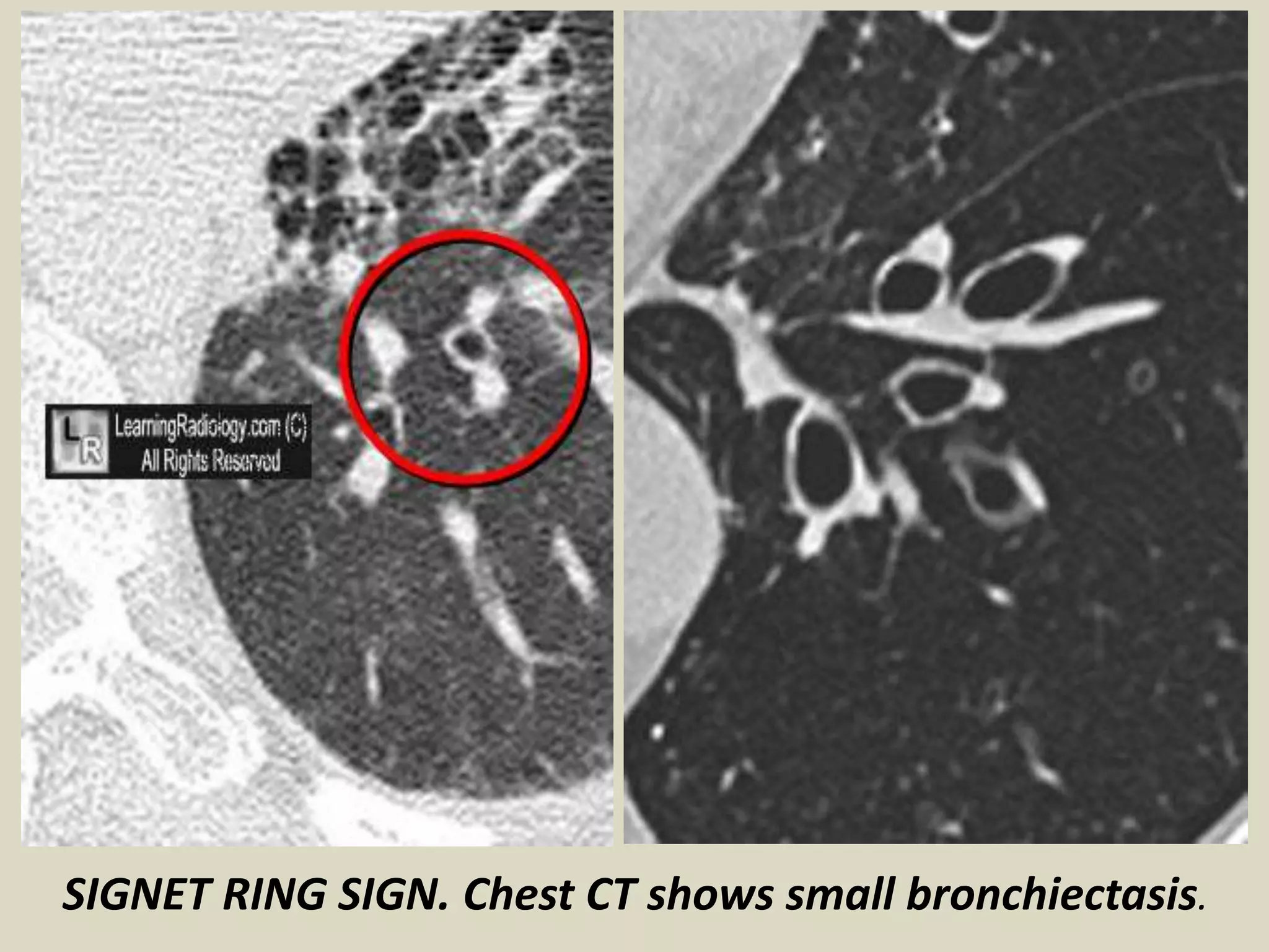 Presentation1.pptx, radiological imaging of bronchiectasis. | PPTX