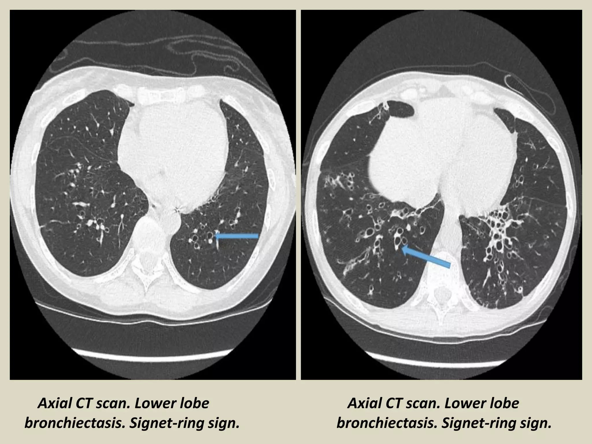 Presentation1.pptx, radiological imaging of bronchiectasis. | PPTX