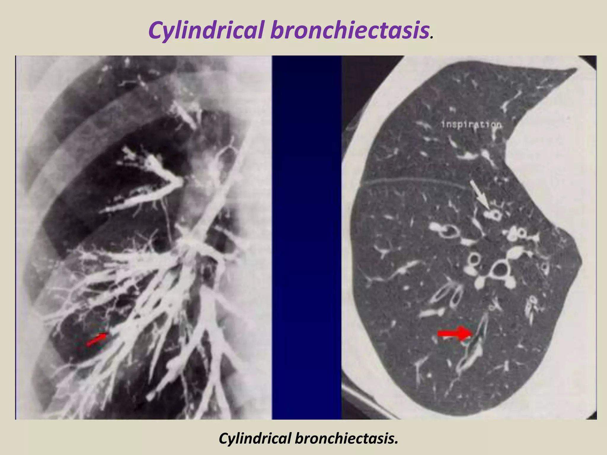 Presentation1.pptx, radiological imaging of bronchiectasis. | PPTX