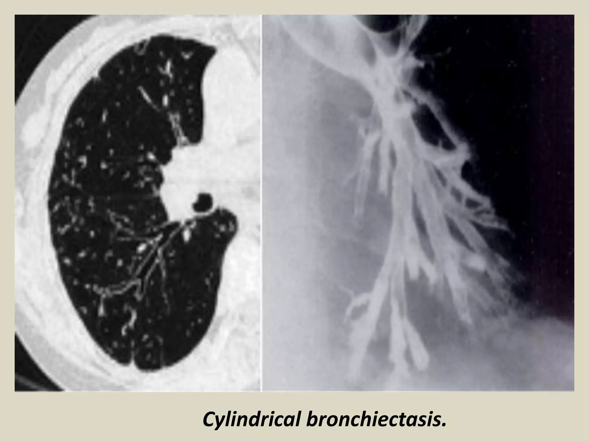 Presentation1.pptx, radiological imaging of bronchiectasis. | PPTX