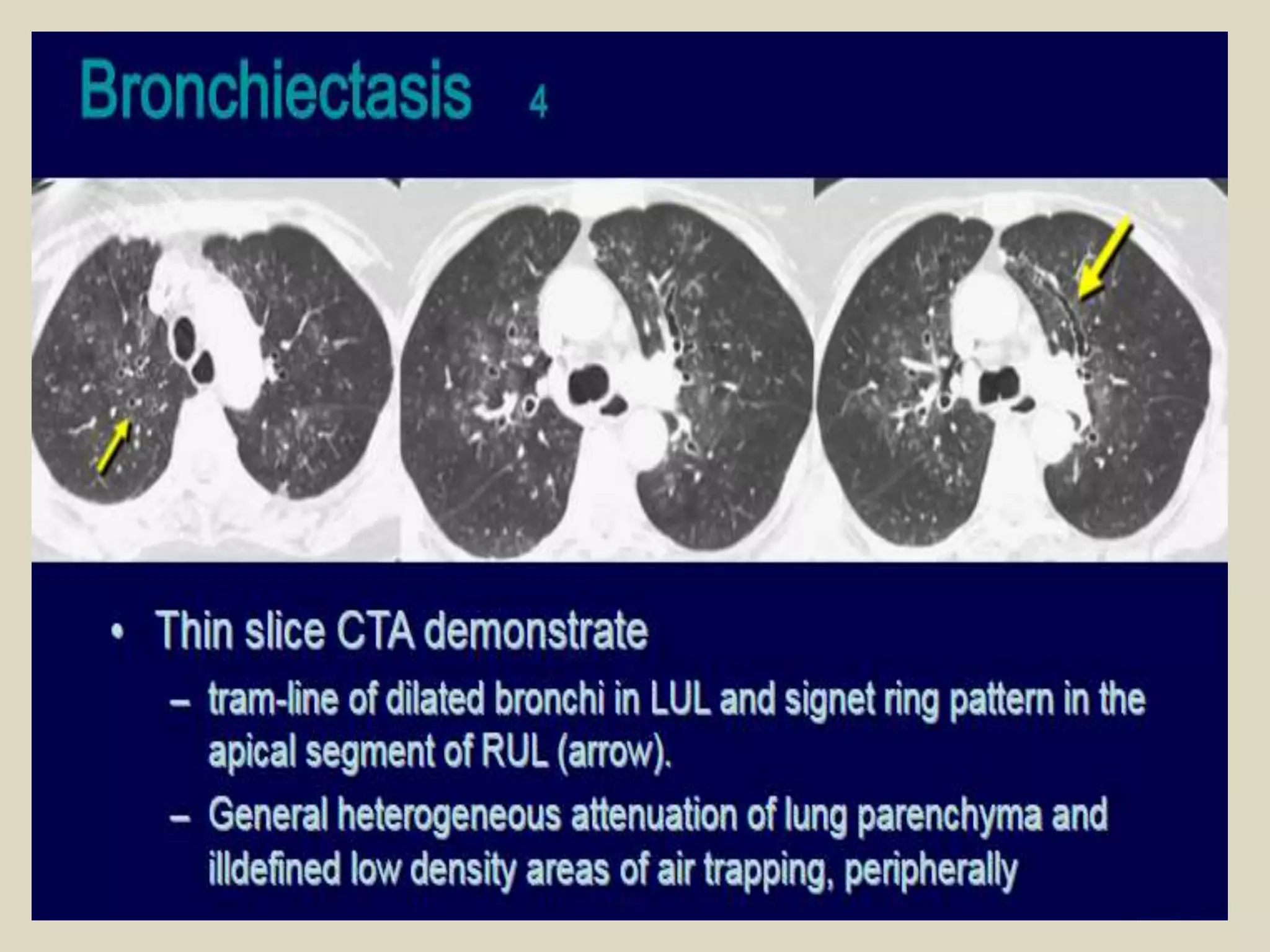 Presentation1.pptx, radiological imaging of bronchiectasis. | PPTX