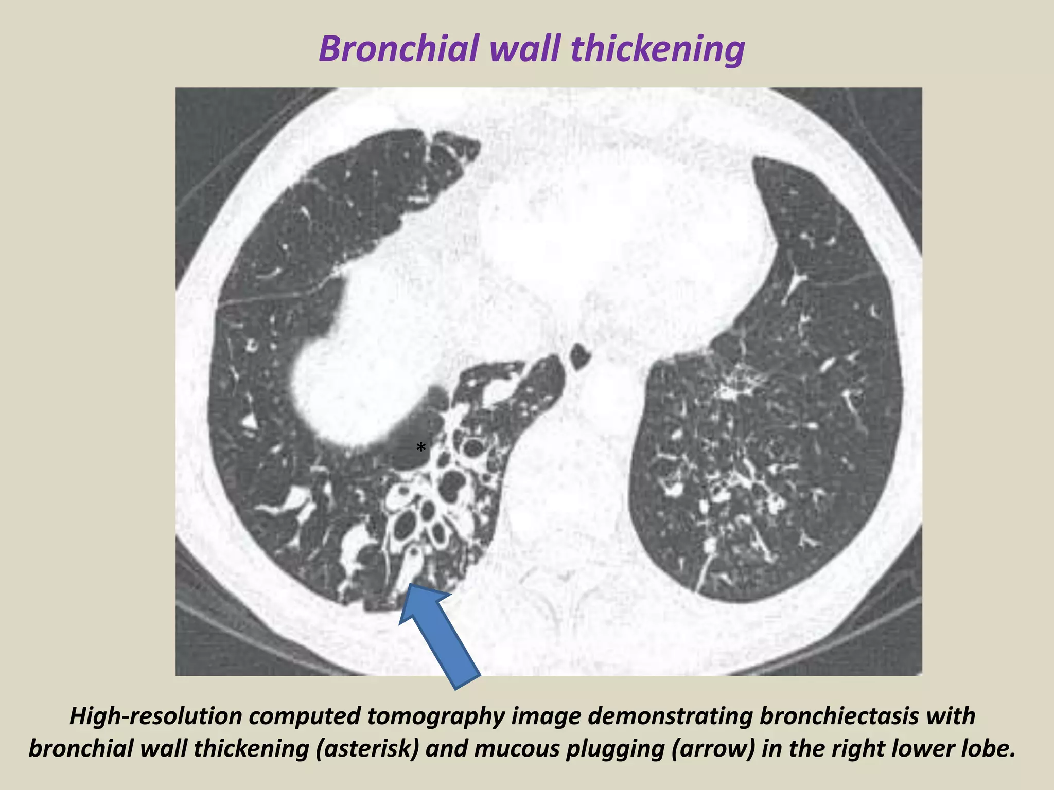 Presentation1.pptx, radiological imaging of bronchiectasis. | PPTX