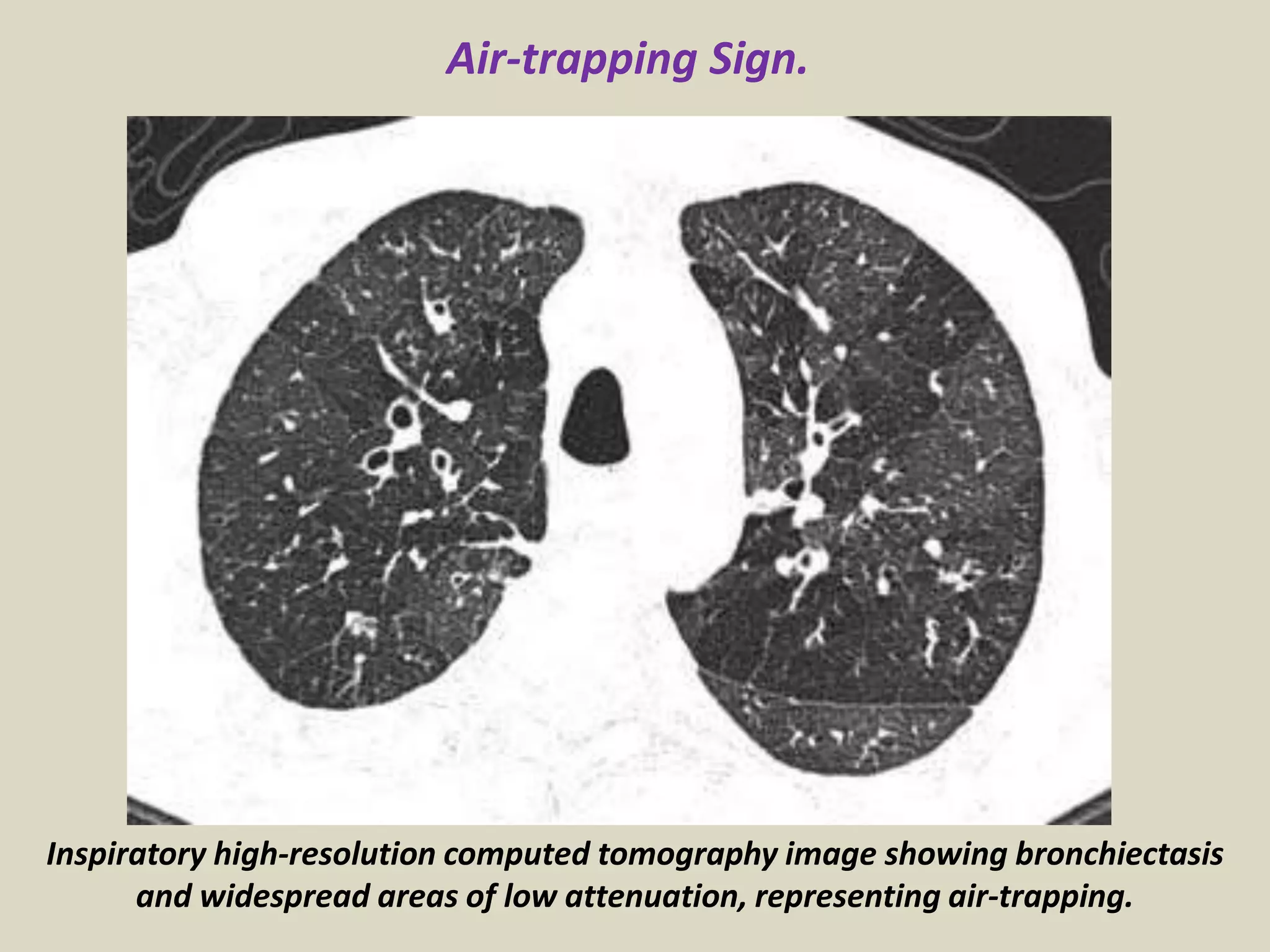 Presentation1.pptx, radiological imaging of bronchiectasis. | PPTX