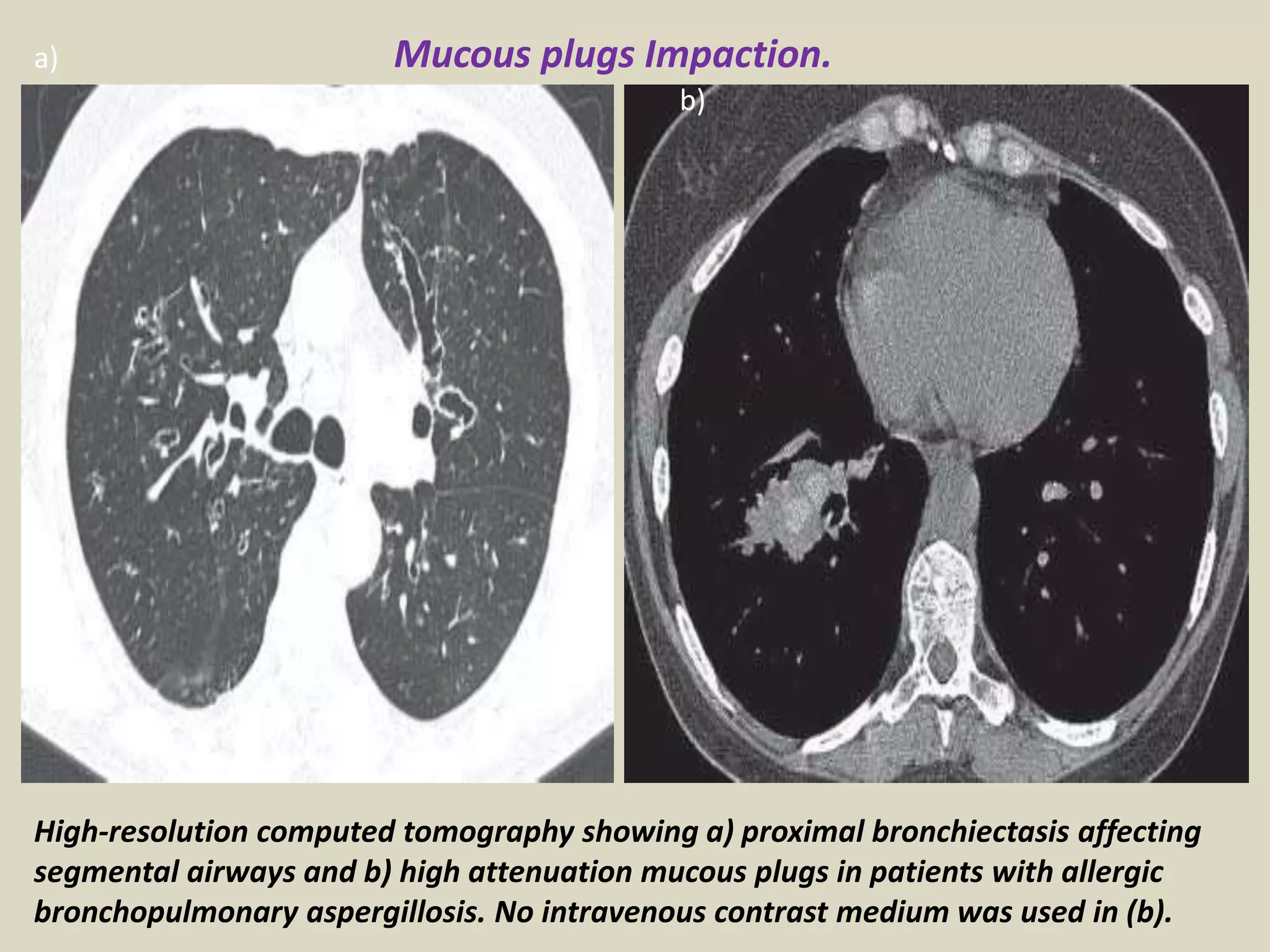 Presentation1.pptx, radiological imaging of bronchiectasis. | PPTX