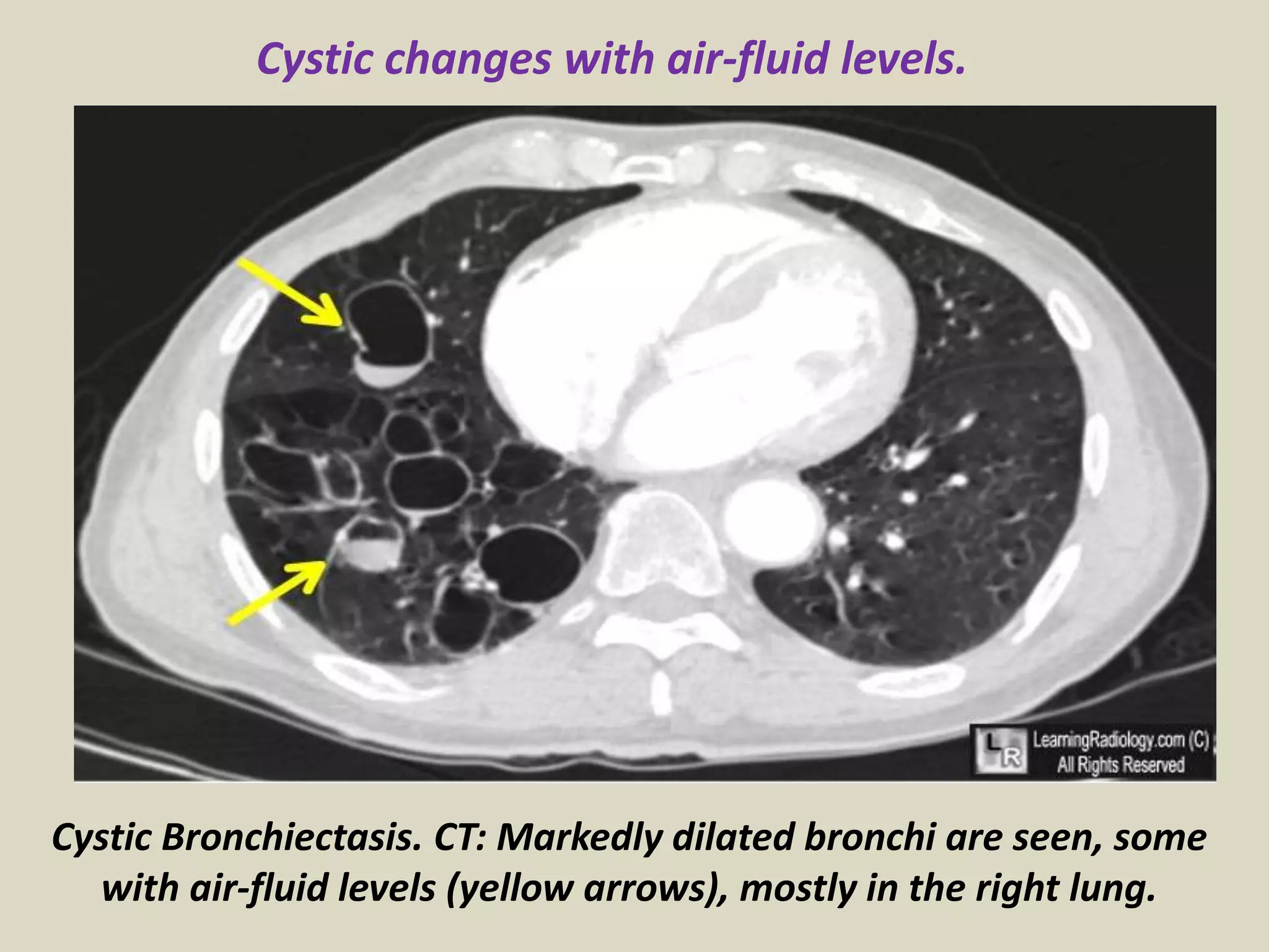 Presentation1.pptx, radiological imaging of bronchiectasis. | PPTX