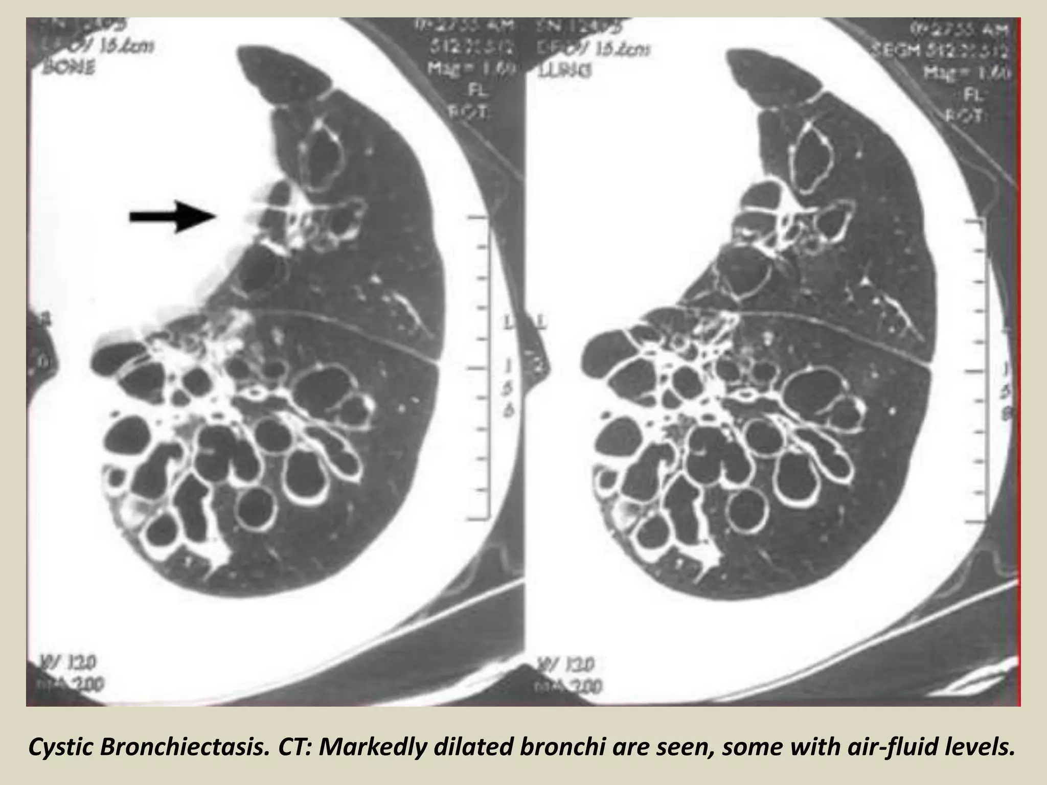 Presentation1.pptx, radiological imaging of bronchiectasis. | PPTX