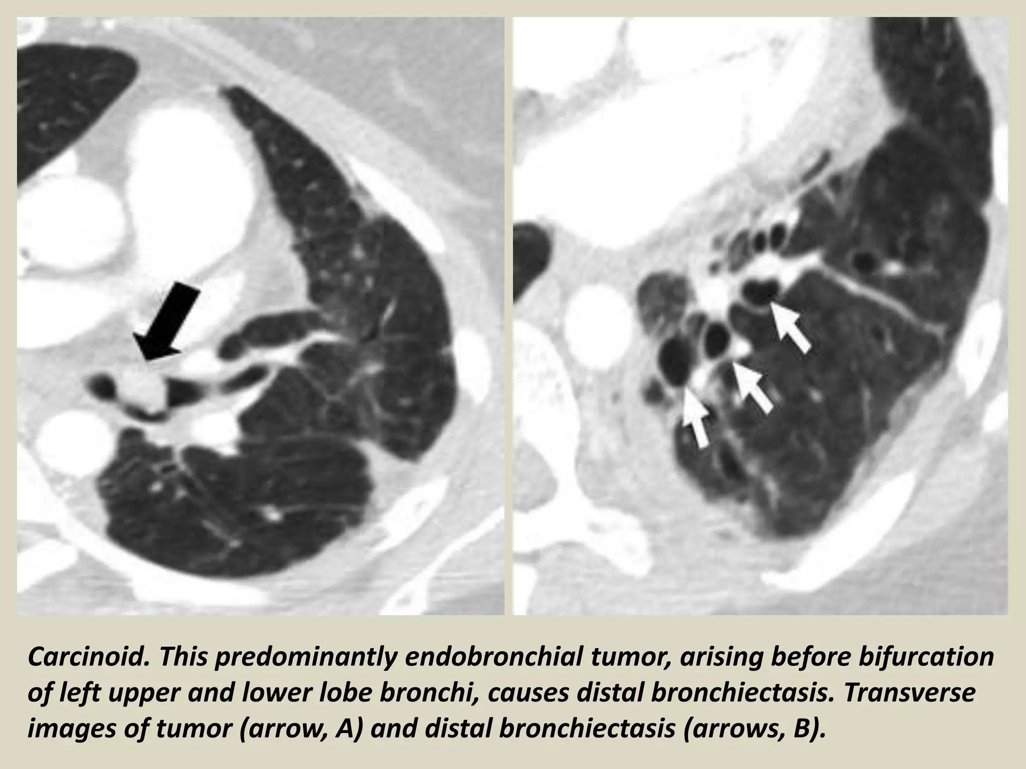 Presentation1.pptx, radiological imaging of bronchiectasis. | PPTX