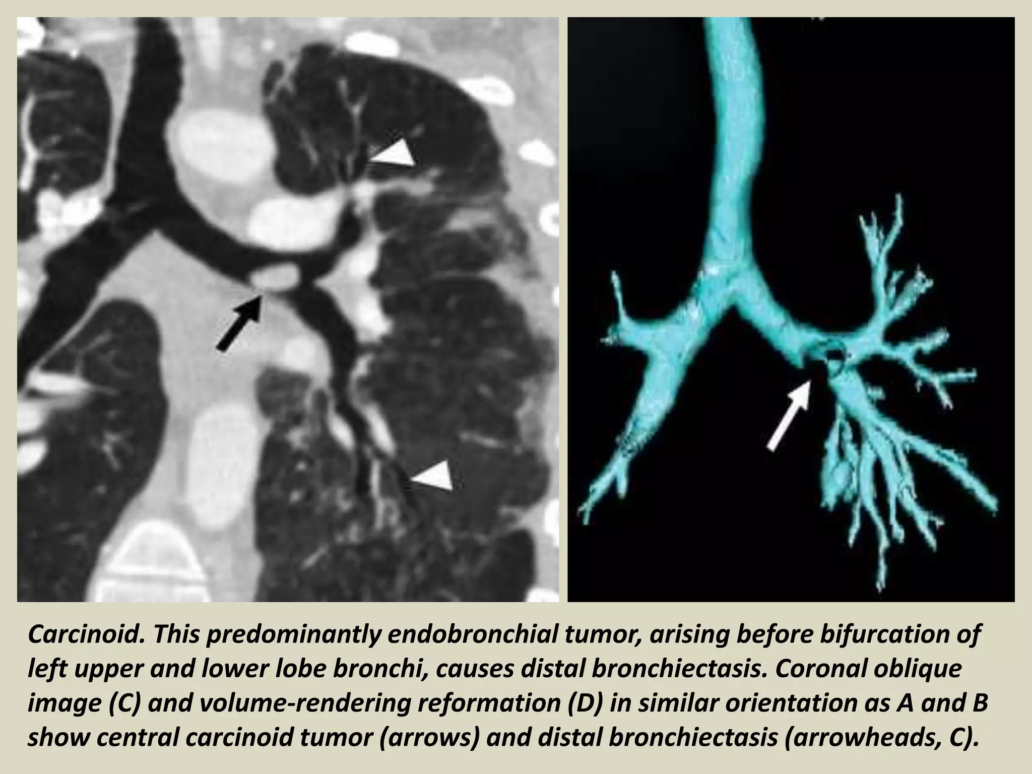 Presentation1.pptx, radiological imaging of bronchiectasis. | PPTX