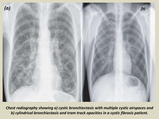 Bronchiectasis X Ray Tram Track