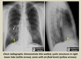 Bronchiectasis X Ray