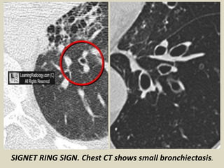 Presentation1.pptx, radiological imaging of bronchiectasis. | PPT
