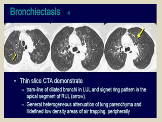 Bronchiectasis X Ray Tram Track