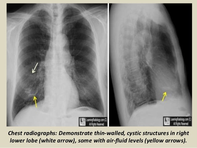 Presentation1.pptx, radiological imaging of bronchiectasis.