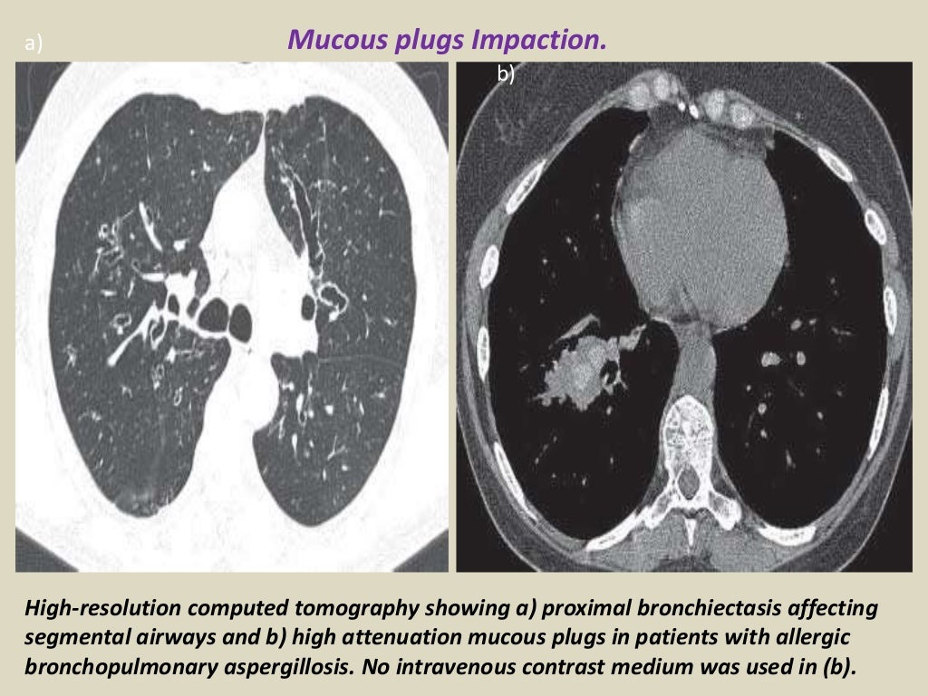 Presentation1.pptx, radiological imaging of bronchiectasis.