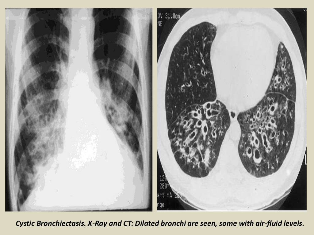 Presentation1.pptx, radiological imaging of bronchiectasis.