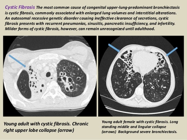 Presentation1.pptx, radiological imaging of bronchiectasis.