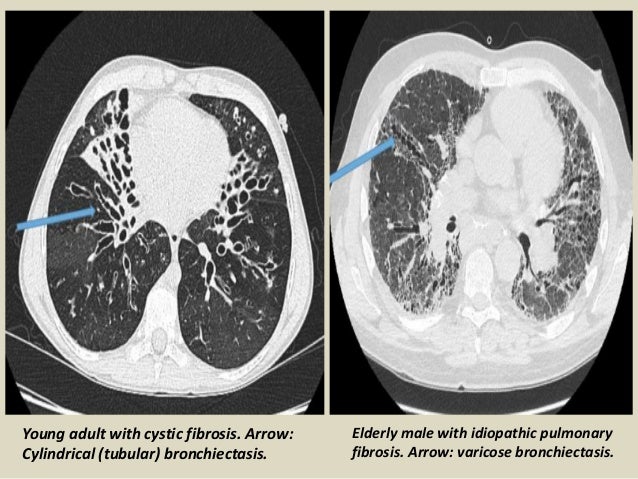 Presentation1.pptx, radiological imaging of bronchiectasis.